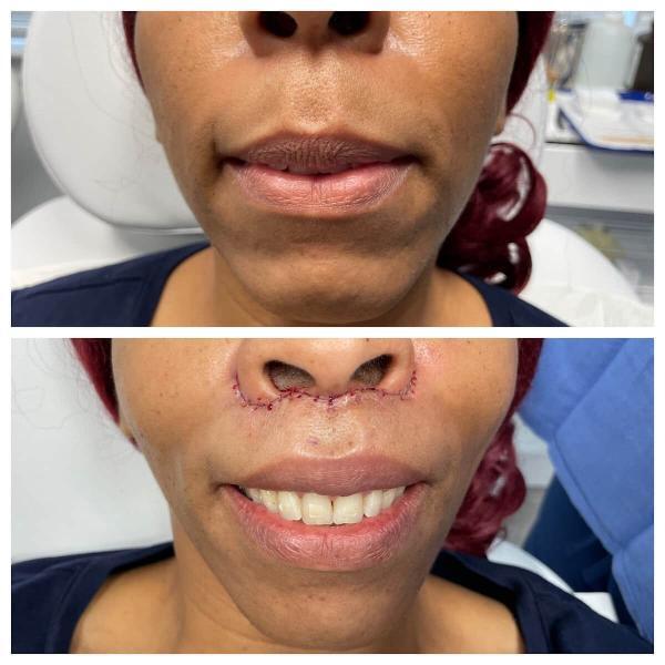Lip Lift Jacksonville Upper Corner Lip Lift Lip Lift Jacksonville Upper Corner Lip Lift