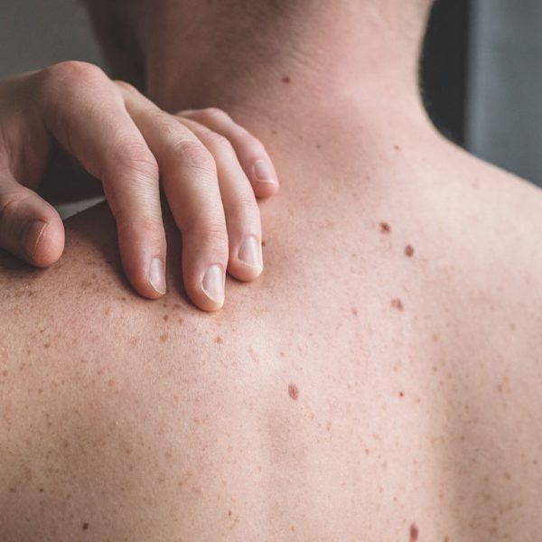Why Am I Getting Skin Tags All of a Sudden?