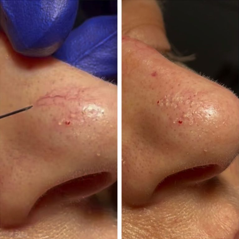 Blood Vessel Treatment on Nose Before and After