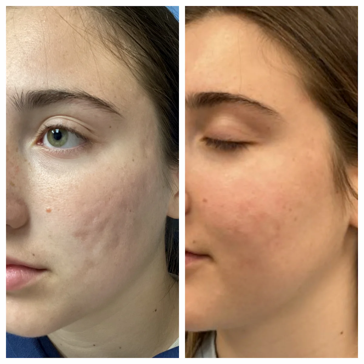 TCA CROSS for Acne Scars: How It Works and Who It’s Best For